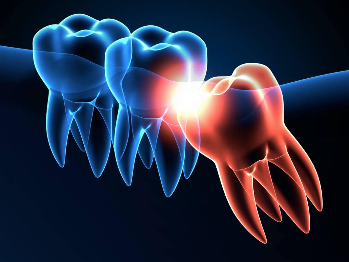 Signs of Wisdom Teeth Pain - Bedford Dental Group Cosmetic Dentists- Blog